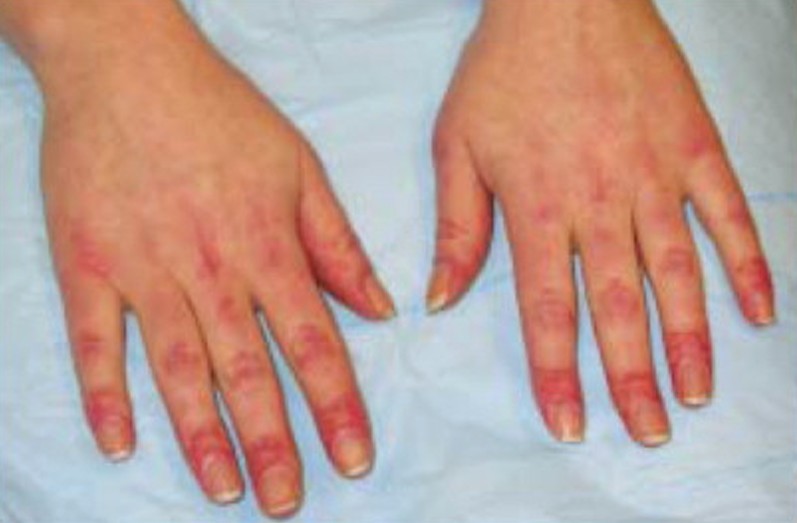 Causes And Treatment Of Small Red Bumps On Hands New Health Advisor Causes And Treatment Of Small Red Bumps On Hands New Health Advisor