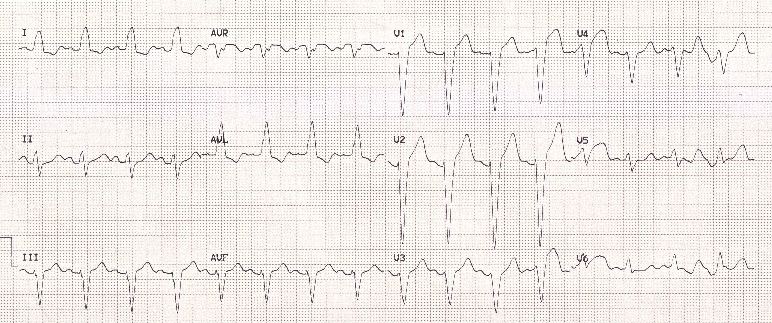 Left Bundle Branch Block | New Health Advisor