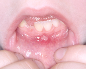 Mouth Ulcers in Children | New Health Advisor