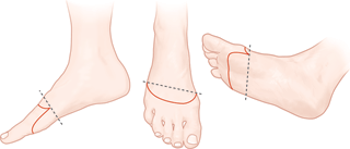 Transmetatarsal Amputation | New Health Advisor
