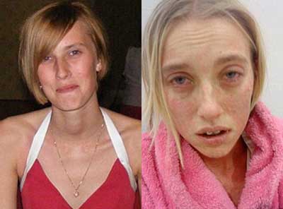 What Is Steven Johnson Syndrome? | New Health Advisor