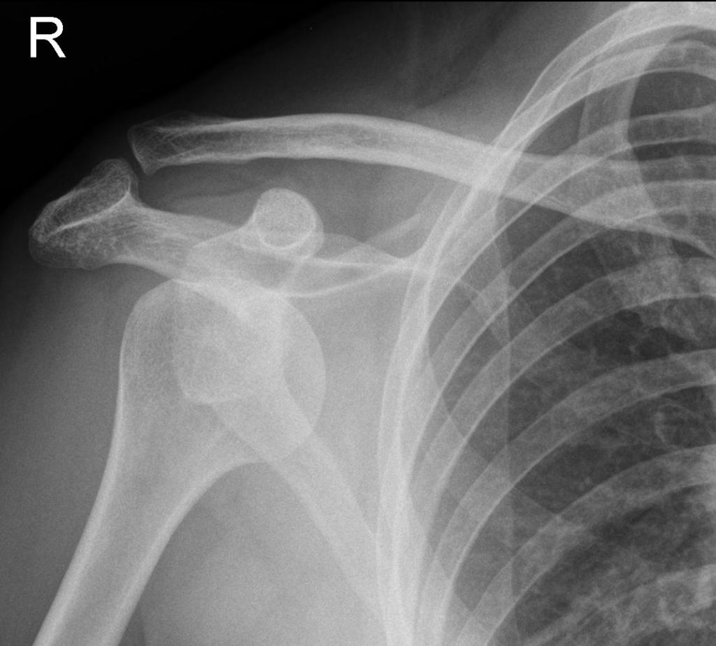 Shoulder Dislocation X Ray | New Health Advisor