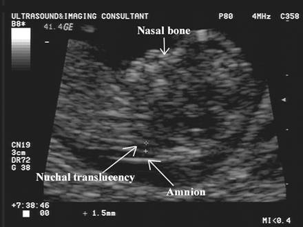 Nuchal Translucency (NT) Normal Range | New Health Advisor