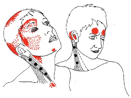 Pain in Sternocleidomastoid: Symptoms, Causes and Treatment | New ...