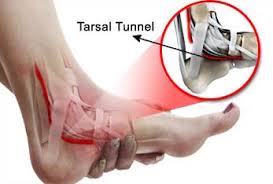 Pinched Nerve in Foot | New Health Advisor