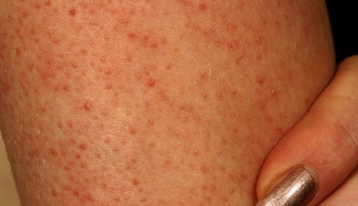 What Causes Little Red Dot on the Skin? | New Health Advisor