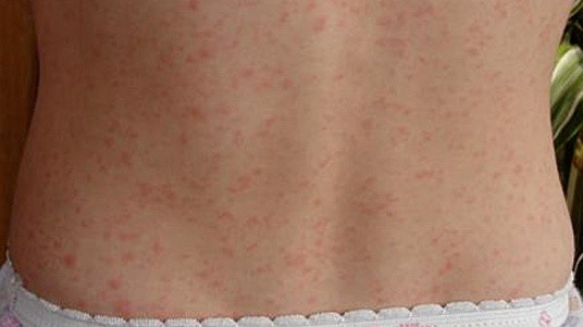 What Causes Little Red Dot on the Skin? | New Health Advisor