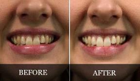 Oil Pulling Before and After (with Pictures) | New Health Advisor
