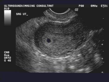 Ultrasound at 4 Weeks | New Health Advisor