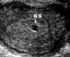 Ultrasound at 4 Weeks | New Health Advisor