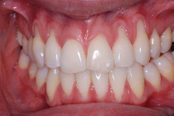 Receding Gums Grow Back | New Health Advisor