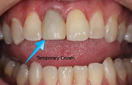 Things to Do When Your Temporary Crown Fell Off | New Health Advisor