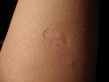 What Does a Scar from Smallpox Vaccination Look Like? | New Health Advisor