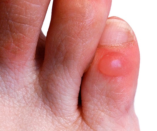 5 Major Foot Bumps and How to Deal with Them | New Health Advisor