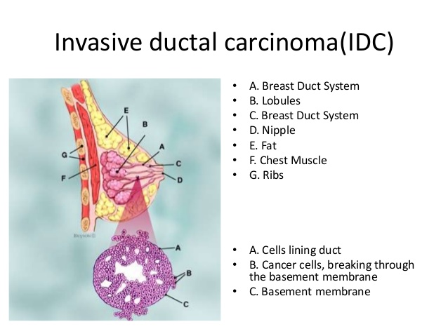 Invasive Ductal Carcinoma | New Health Advisor