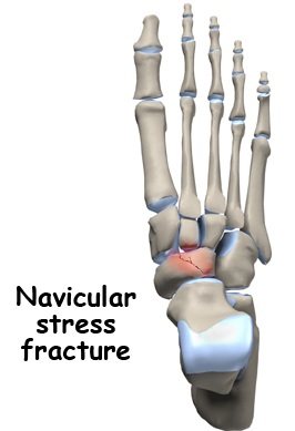 What Is Navicular Stress Fracture? | New Health Advisor