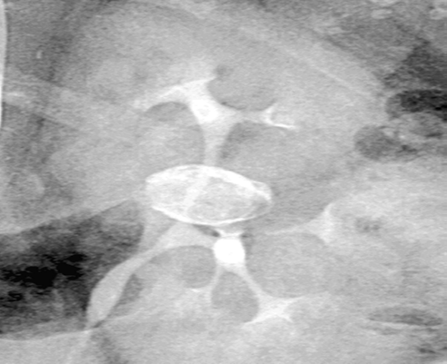 Splenic Artery Aneurysm | New Health Advisor
