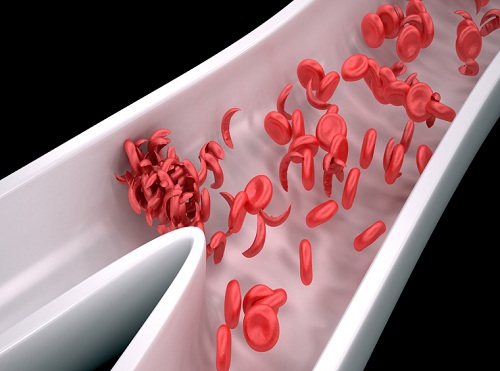 How to Treat Splenic Sequestration | New Health Advisor