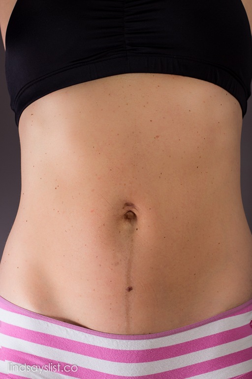 Remedies To Get Rid Of Linea Nigra If You re Not Pregnant TSMP Medical Blog TSMP Medical Blog