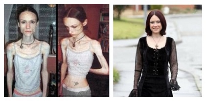 Anorexia Before and After | New Health Advisor