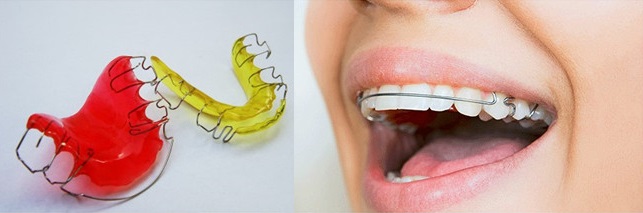 Retainer Before and After | New Health Advisor