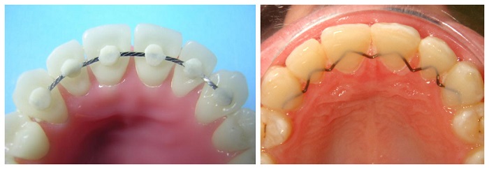 Retainer Before and After | New Health Advisor