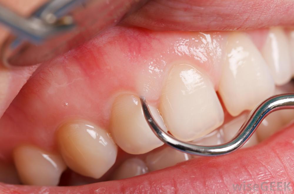 Why Do I Have White Colored Gums Around the Teeth? | New Health Advisor