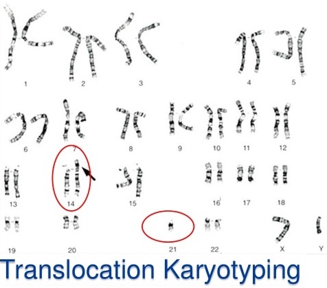 Down Syndrome Karyotype | New Health Advisor