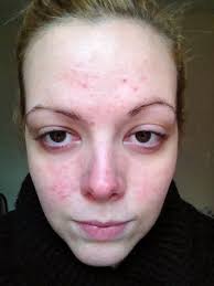 Why Is My Nose Always Red? | New Health Advisor