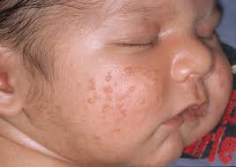 What Causes Small Bumps on Baby Face? | New Health Advisor