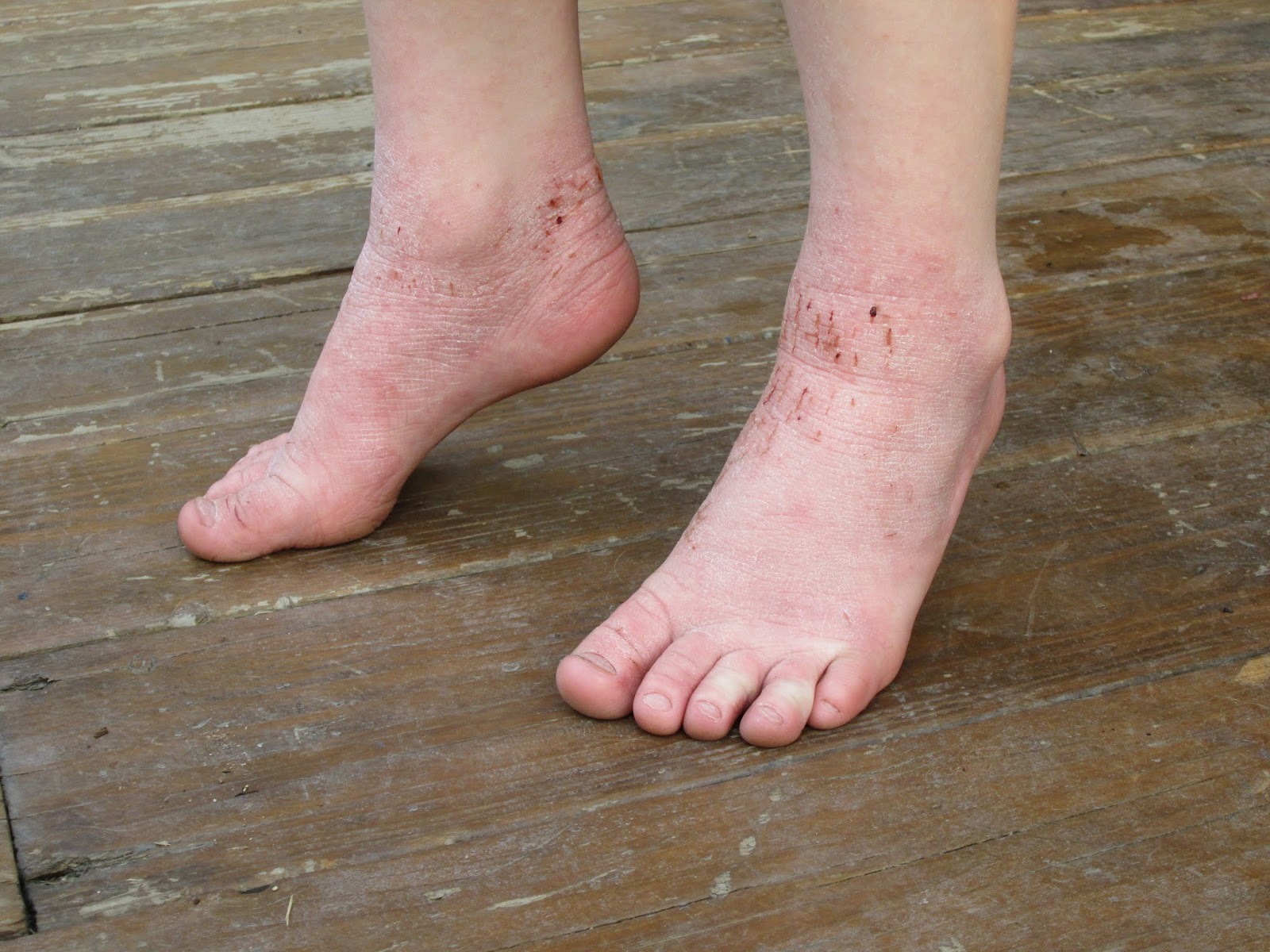 Treatment For Red Itchy Rash On Feet at Michael Nehls blog