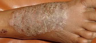 Itchy Rash on Top of Foot: Causes and Treatments | New Health Advisor