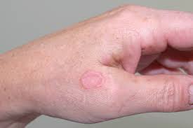 Causes and Treatment of Small Red Bumps on Hands | New Health Advisor