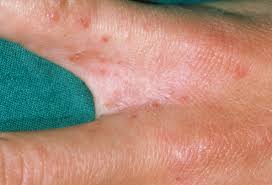 Causes and Treatment of Small Red Bumps on Hands | New Health Advisor
