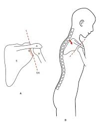 Try 8 Best Winged Scapula Exercises to Help | New Health Advisor