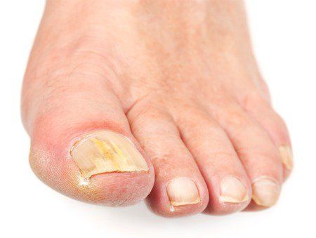 Step by Step Guide to Soften and Cut Toenails | New Health Advisor