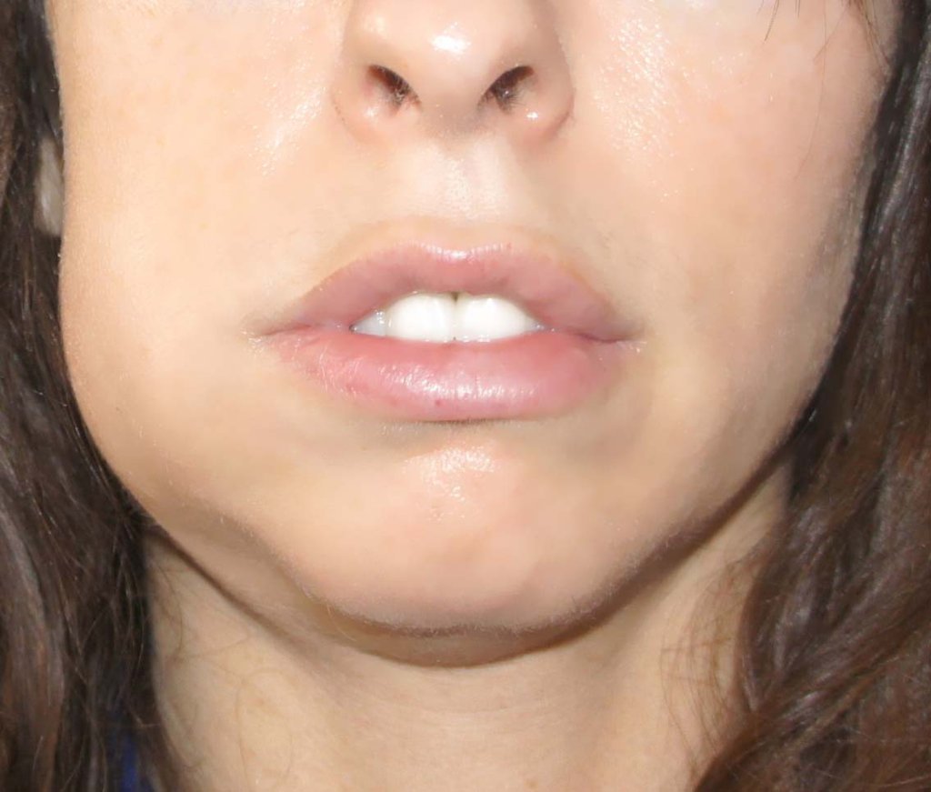 Swollen Face from Tooth Infection | New Health Advisor