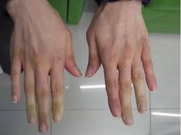 Poor Circulation in Fingers | New Health Advisor