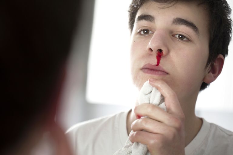 Why Do I Keep Getting Bloody Noses? | New Health Advisor