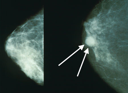 Movable Lump in Breast | New Health Advisor