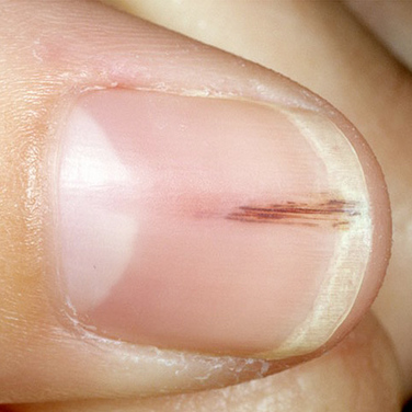 No Moons on Fingernails | New Health Advisor