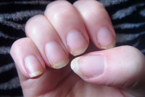 No Moons on Fingernails | New Health Advisor