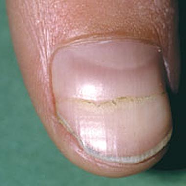 No Moons on Fingernails | New Health Advisor