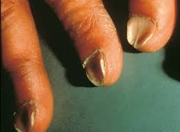 No Moons on Fingernails | New Health Advisor