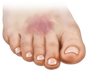 Popped Blood Vessel in Foot | New Health Advisor