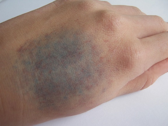 Why Do Bruises Turn Yellow? | New Health Advisor