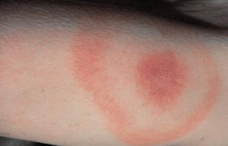 Bug Bite with White Ring Around It | New Health Advisor