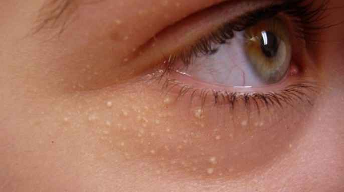 Calcium Deposits on Skin: Symptom, Cause and Treatment | New Health Advisor