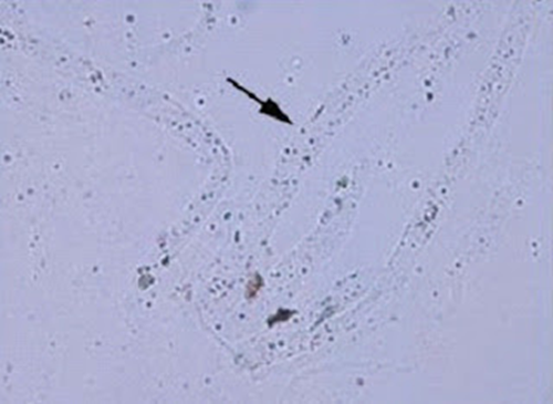 Mucus/White Threads Present in Urine: Causes and Treatments | New ...