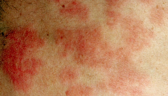 Sun Poisoning Rash Photos | New Health Advisor